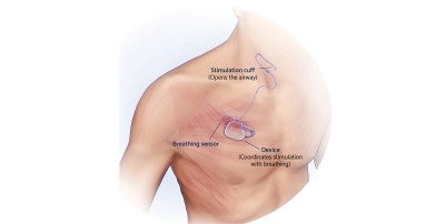 Inspire Therapy Now Offered for CPAP-Intolerant Sleep Apnea